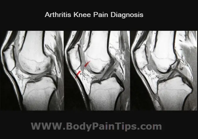 How To Diagnose Arthritis Knee Pain - Body Pain Tips