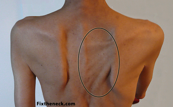 What To Do For A Pulled Muscle In Back