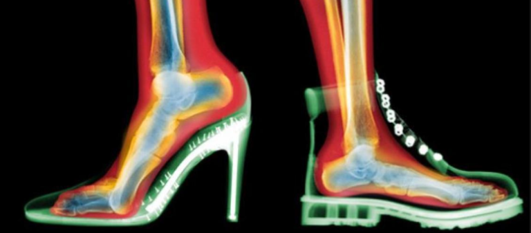 Problems Associated with Fallen Arches